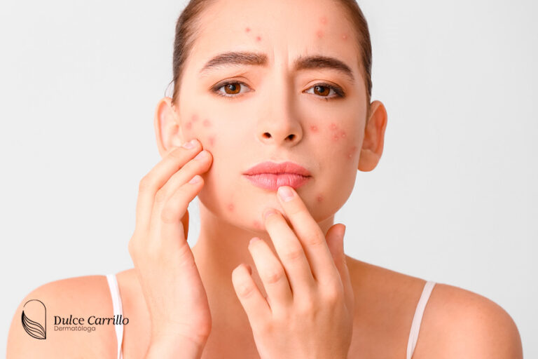 Cómo saber si son granos por estrés - Dermatóloga Dulce Carrillo CDMX