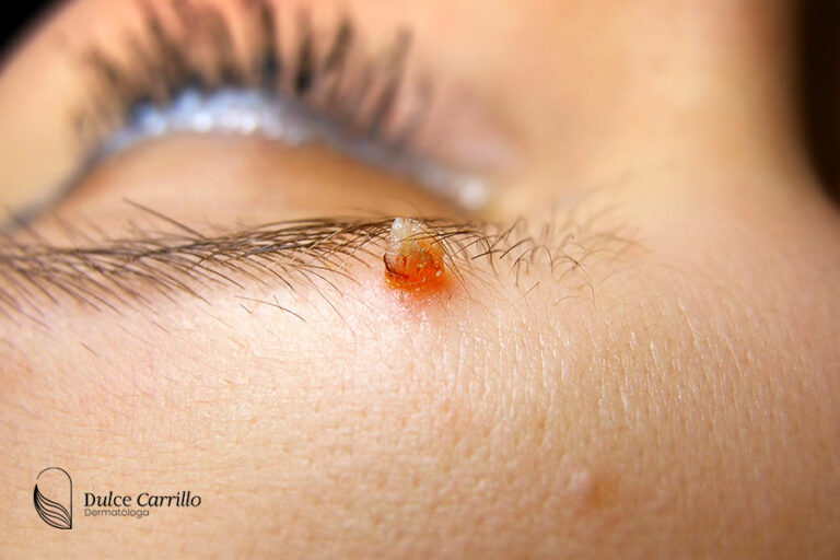 ¿Qué causa las verrugas en la cara? - Dermatóloga Dulce Carrillo CDMX